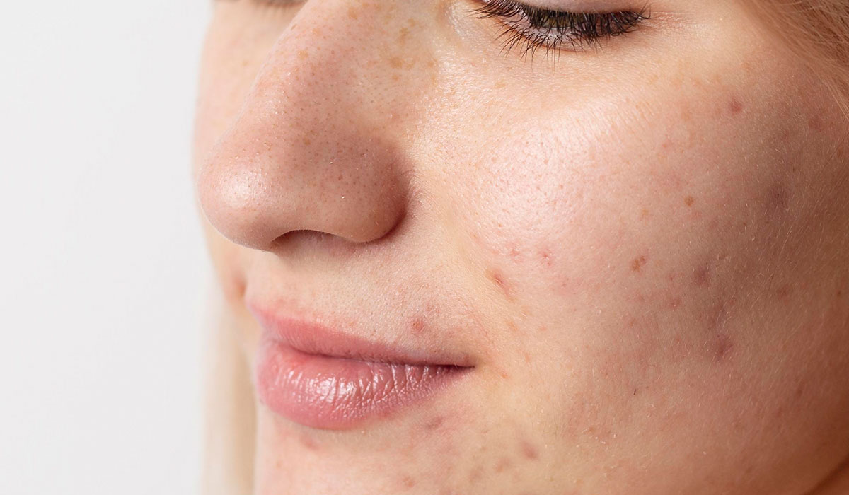 Effective Acne Treatment Solutions for Clear Skin - Nigro Dermatology Group
